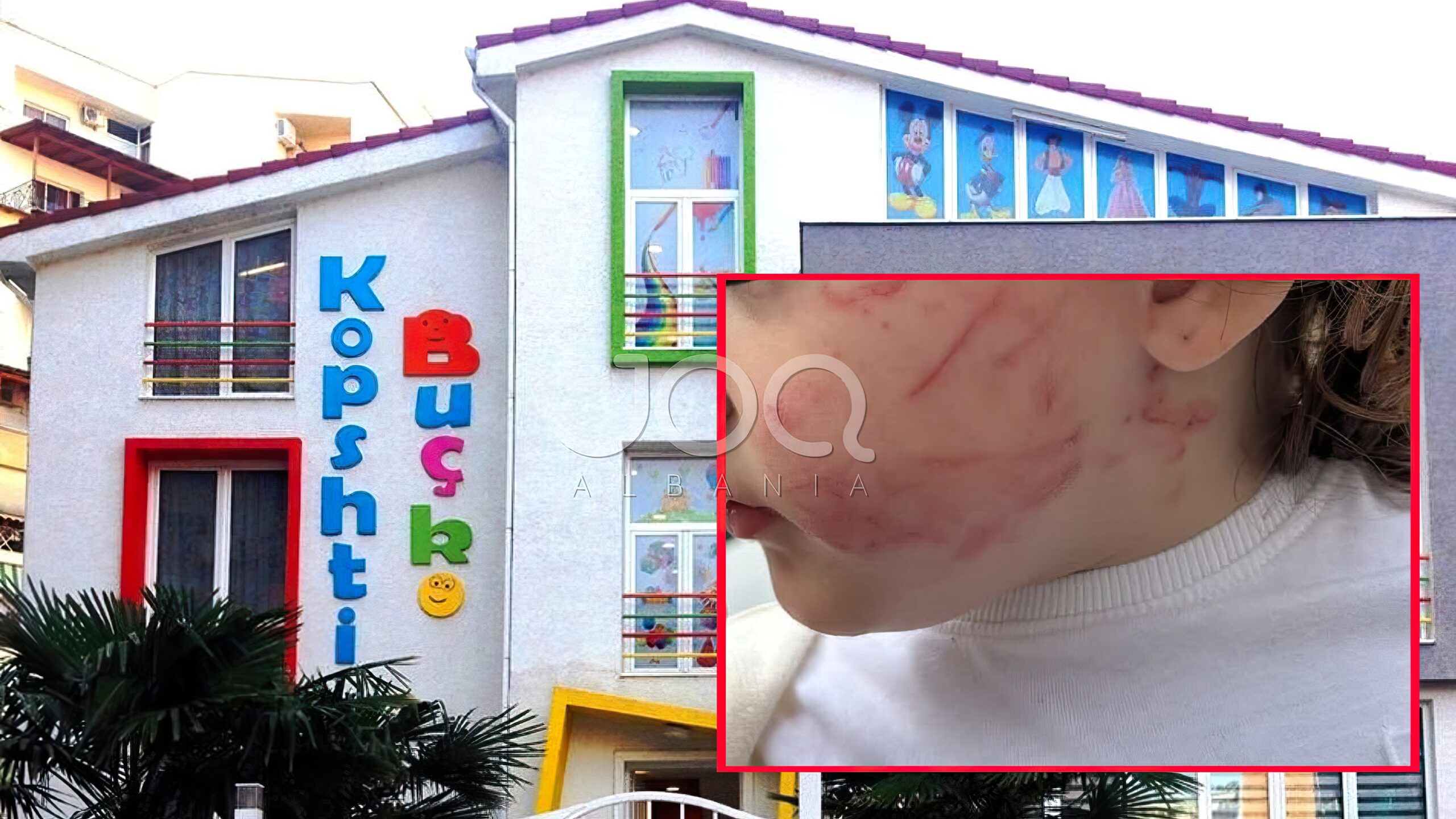 S'kandaI në një kopsht në Tiranë: Dh*në fizike ndaj fëmijës dhe fshehje e ngjarjes - Shqip Info